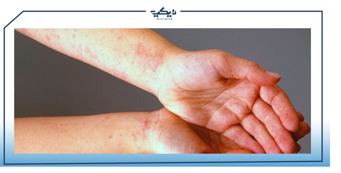 مواصفات اناللرج Anallerge لعلاج الحساسية | ويكي مصر