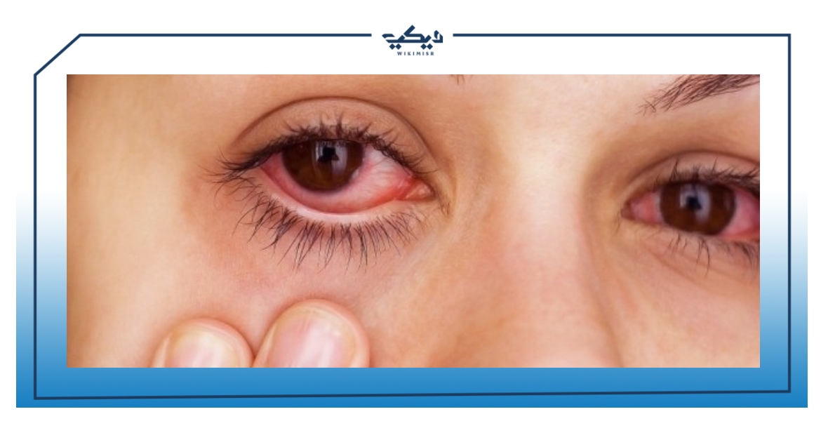 مواصفات وسعر كريم جنتاديرم لعلاج الالتهابات البكتيرية | ويكي مصر