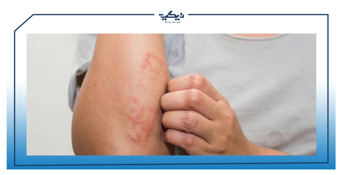 مواصفات وسعر كريم جنتاديرم لعلاج الالتهابات البكتيرية | ويكي مصر