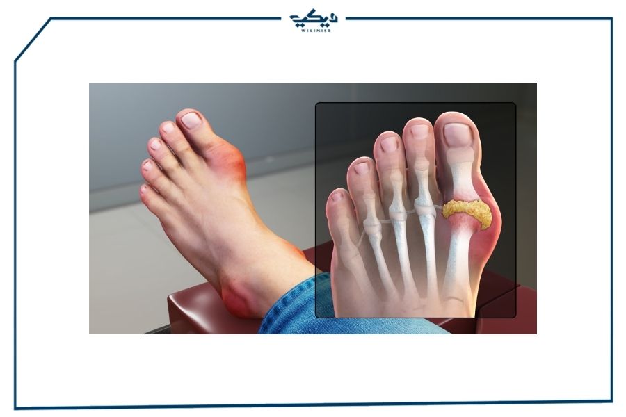 سعر أقراص DONIFOXATE دونيفوكسات لعلاج النقرس | ويكي مصر