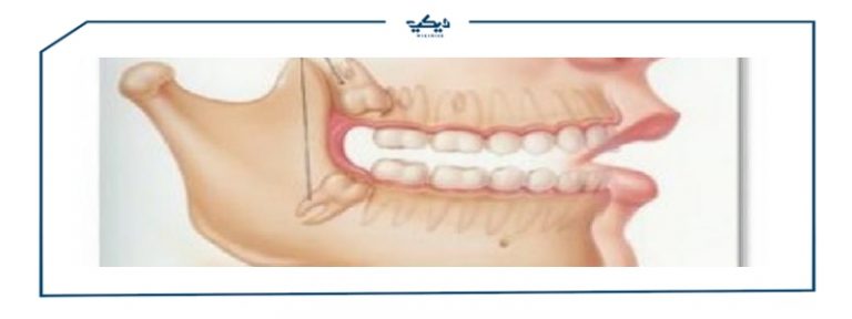 ضرس العقل – معلومات هامة لا تفوتك | ويكي مصر