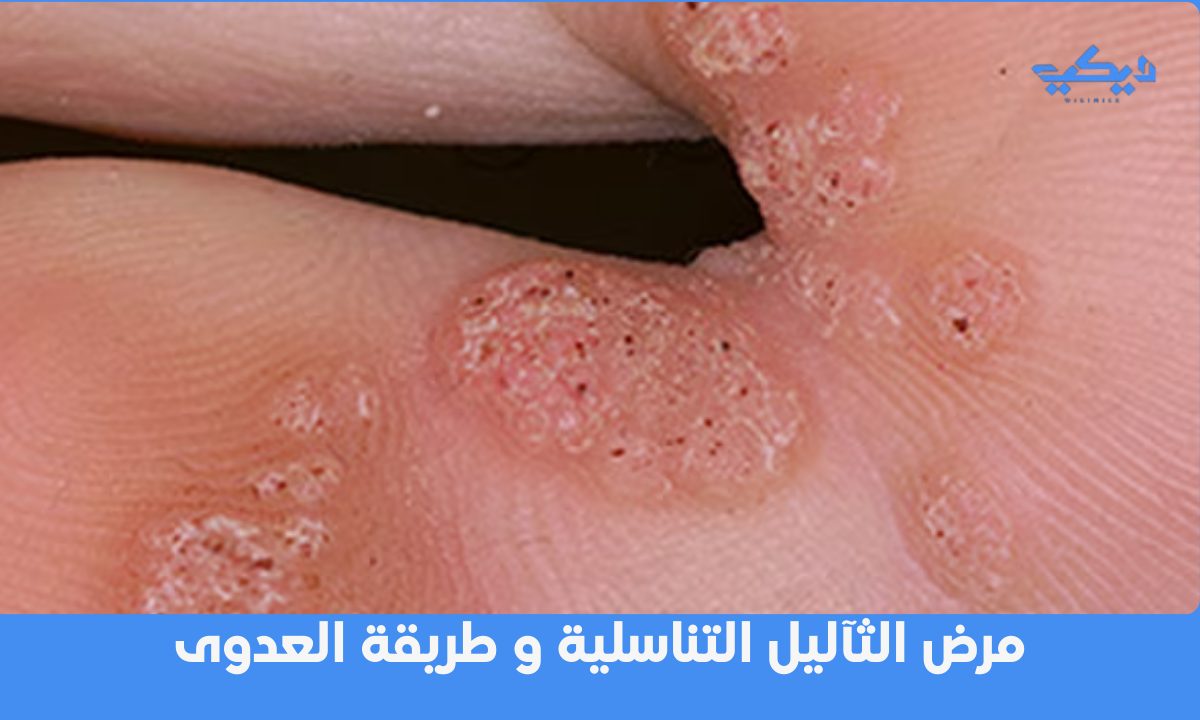 مرض الثآليل التناسلية و طريقة العدوى | ويكي مصر