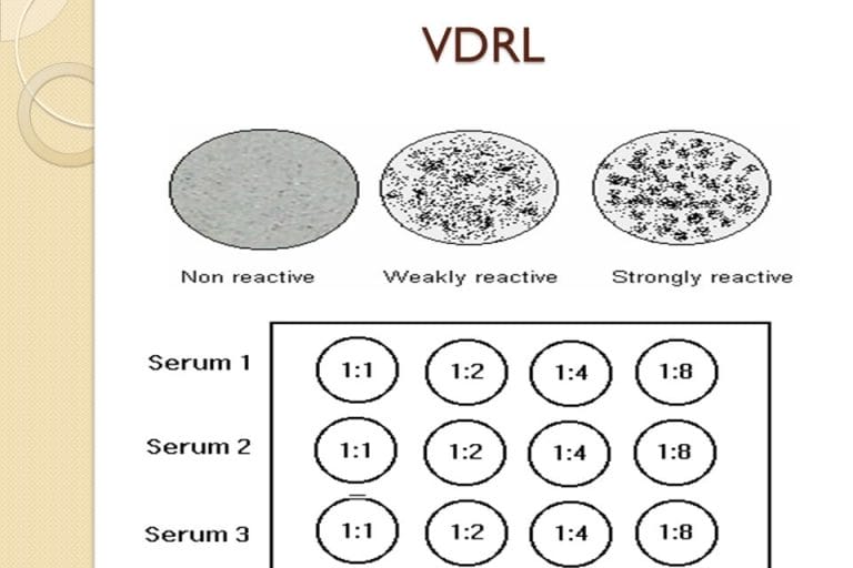 تحليل VDRL وقراءة نتيجة التحليل | ويكي مصر